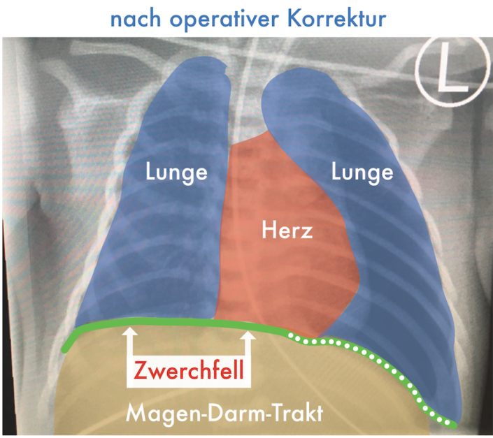 Angeborene Zwerchfellhernie (Congenital diaphragmatic hernia (CDH ...