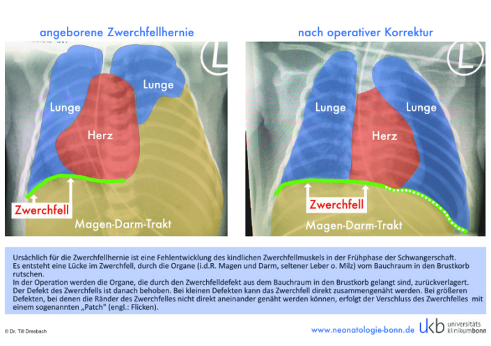 Angeborene Zwerchfellhernie (Congenital diaphragmatic hernia (CDH ...
